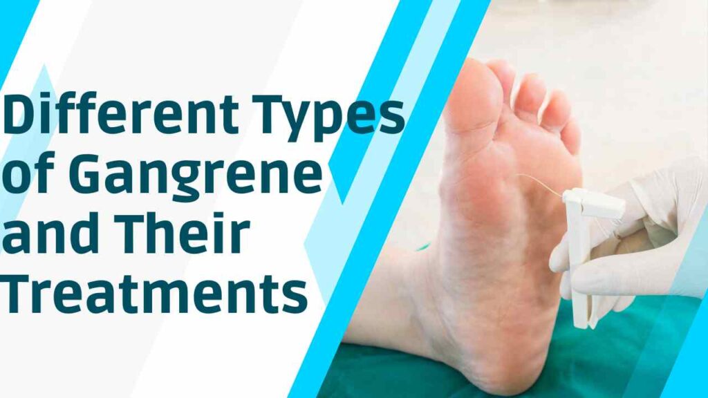Understanding Gangrene and Its Treatment Options