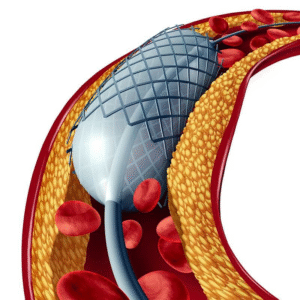 What Is Intracranial Stenting? Procedure, Benefits, Risks
